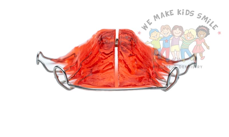 Your Child's Best Smile: What to Know About a Palatal Expander