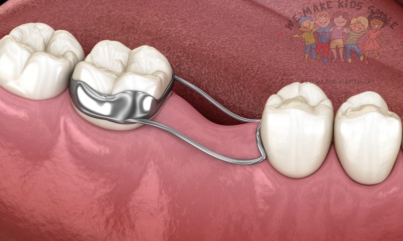 The Role of Space Maintainers in Kids' Orthodontic Care