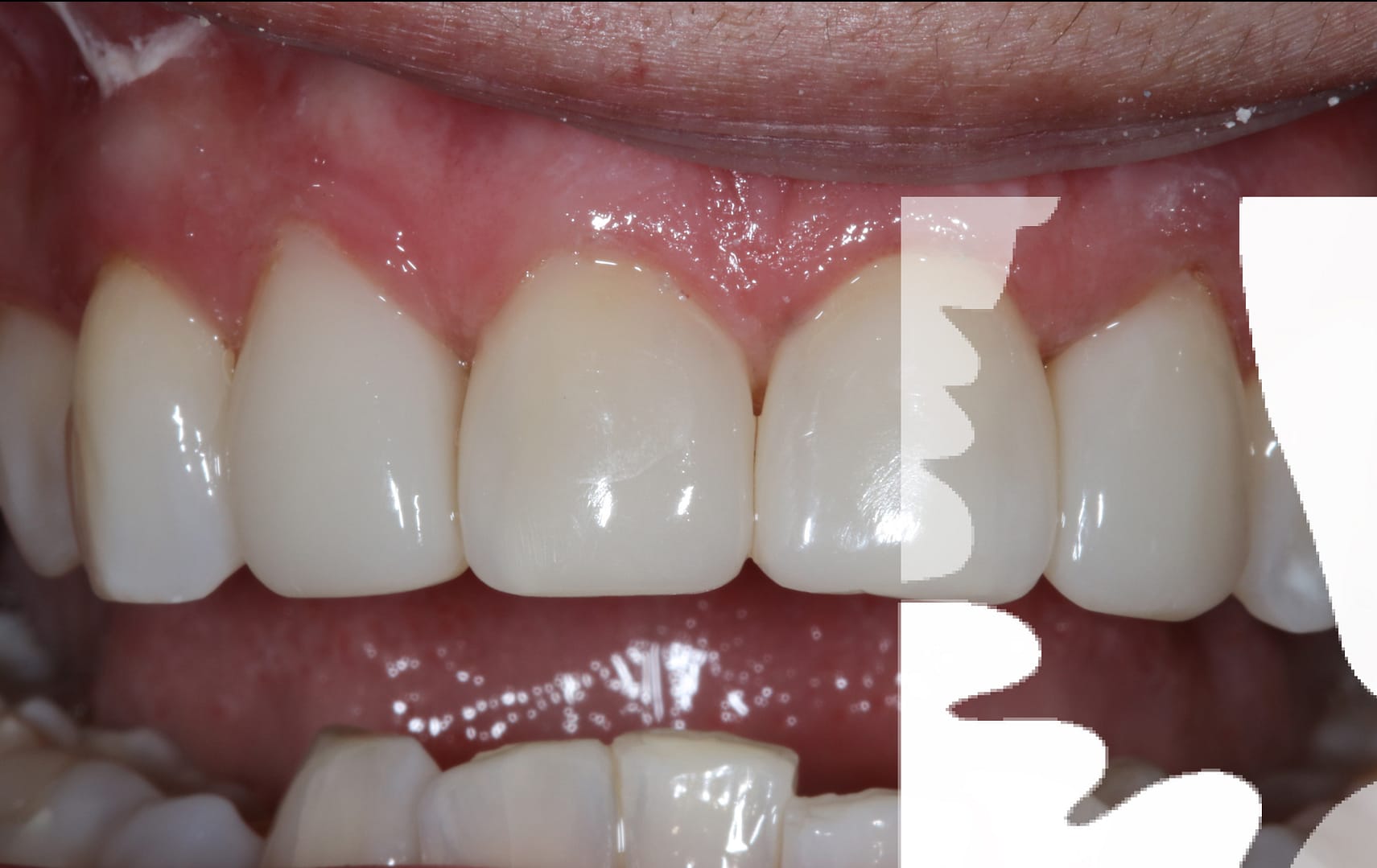 What Is Bioclear? A Guide to This Cosmetic Treatment