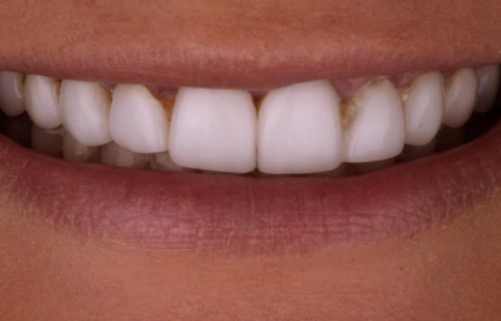 Veneers & Gum Contouring | Luminous Smiles in Newport Beach CA