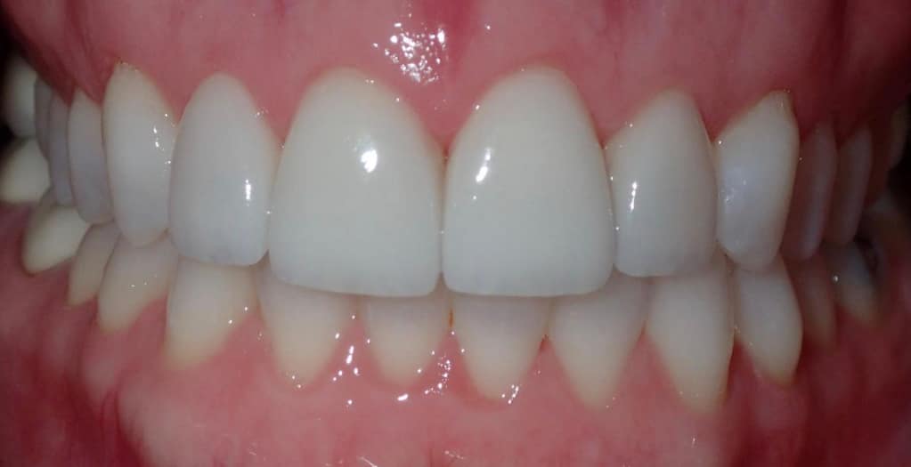Smile Gallery — Restorative Dentistry — Dental Crowns