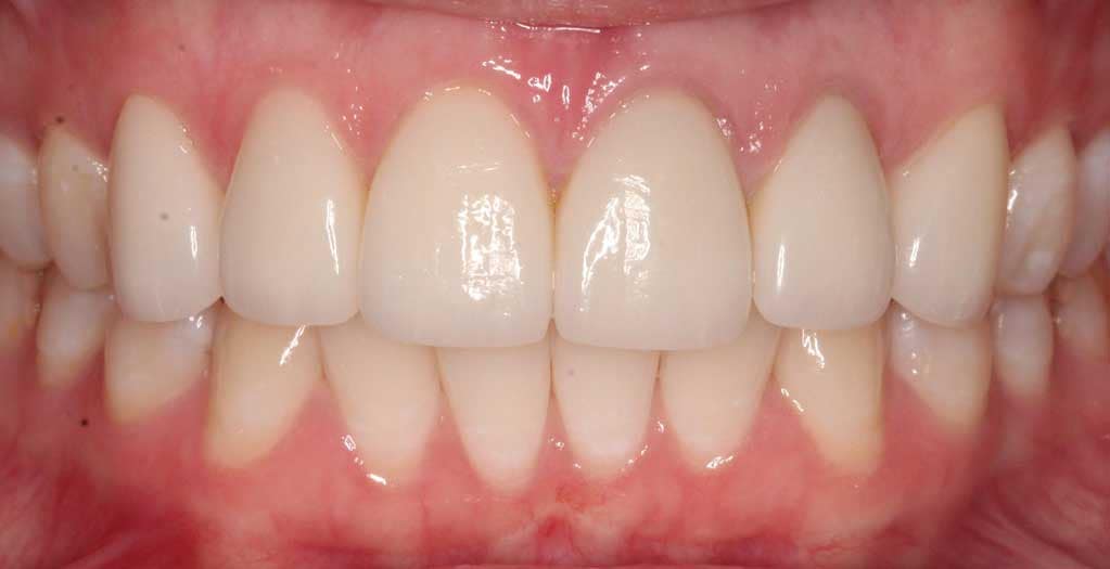 Smile Gallery — Restorative Dentistry — Dental Crowns