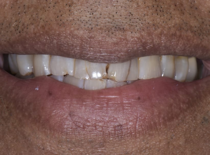 Cracked and Chipped Teeth | Luminous Smiles