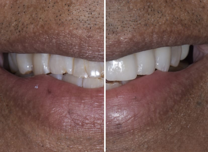 Cracked and Chipped Teeth | Luminous Smiles