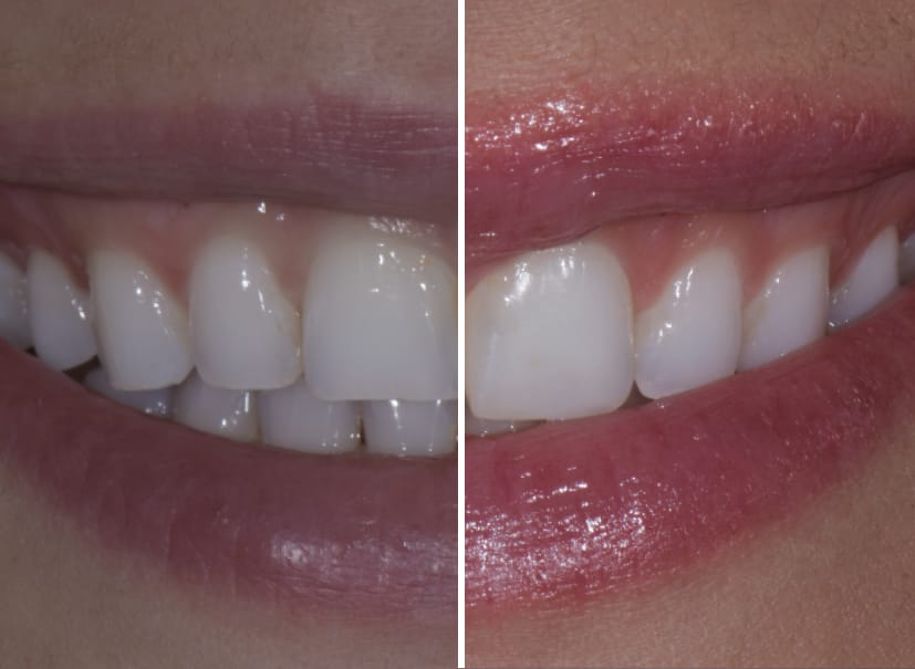 Short Teeth and a Gap | Luminous Smiles