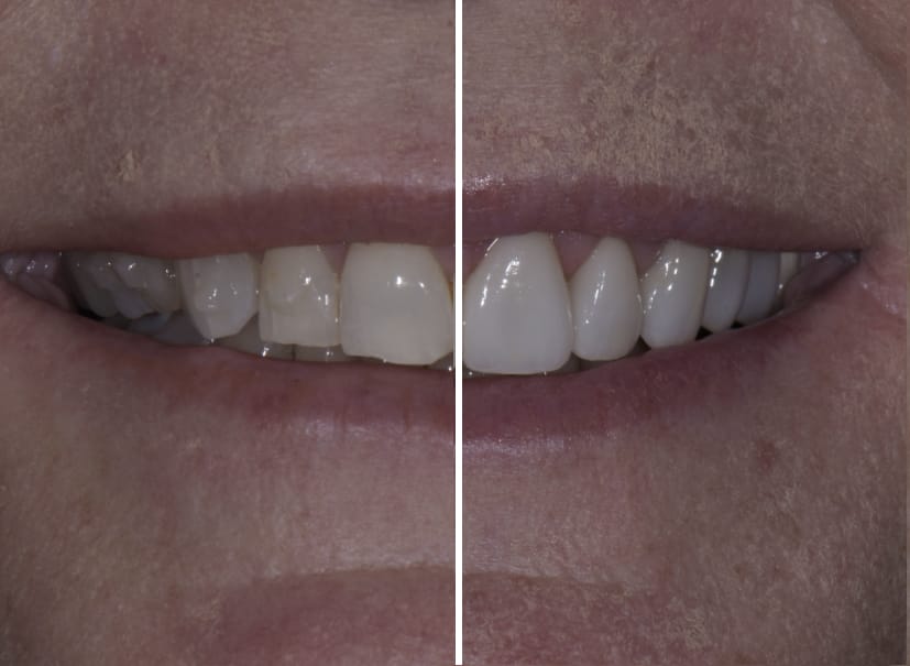 A Natural Smile | Luminous Smiles