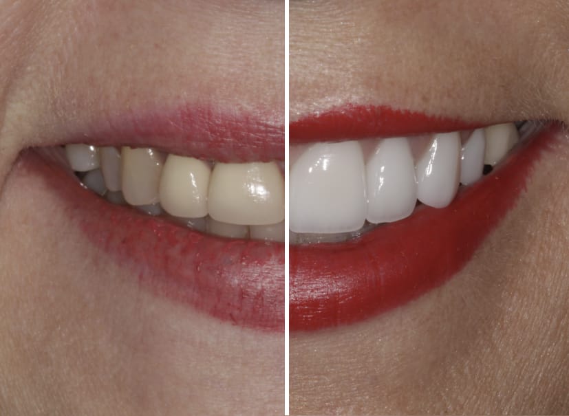Smile Enhancement | Luminous Smiles
