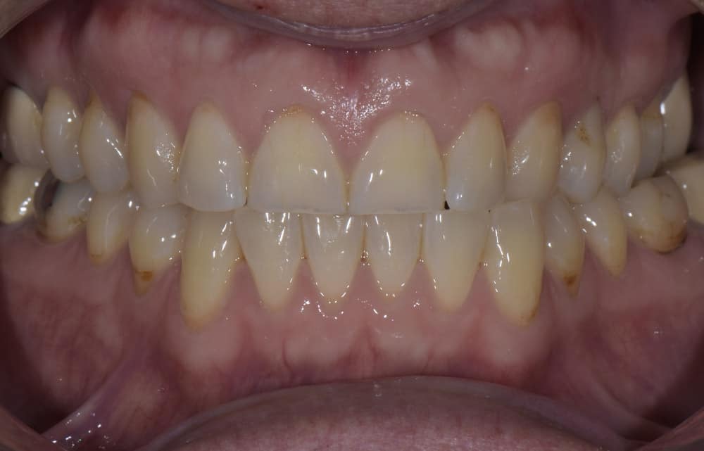 Restorative Dentistry in Newport Beach CA — Luminous Smiles