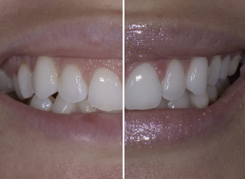 Jagged-edged Front Teeth | Luminous Smiles