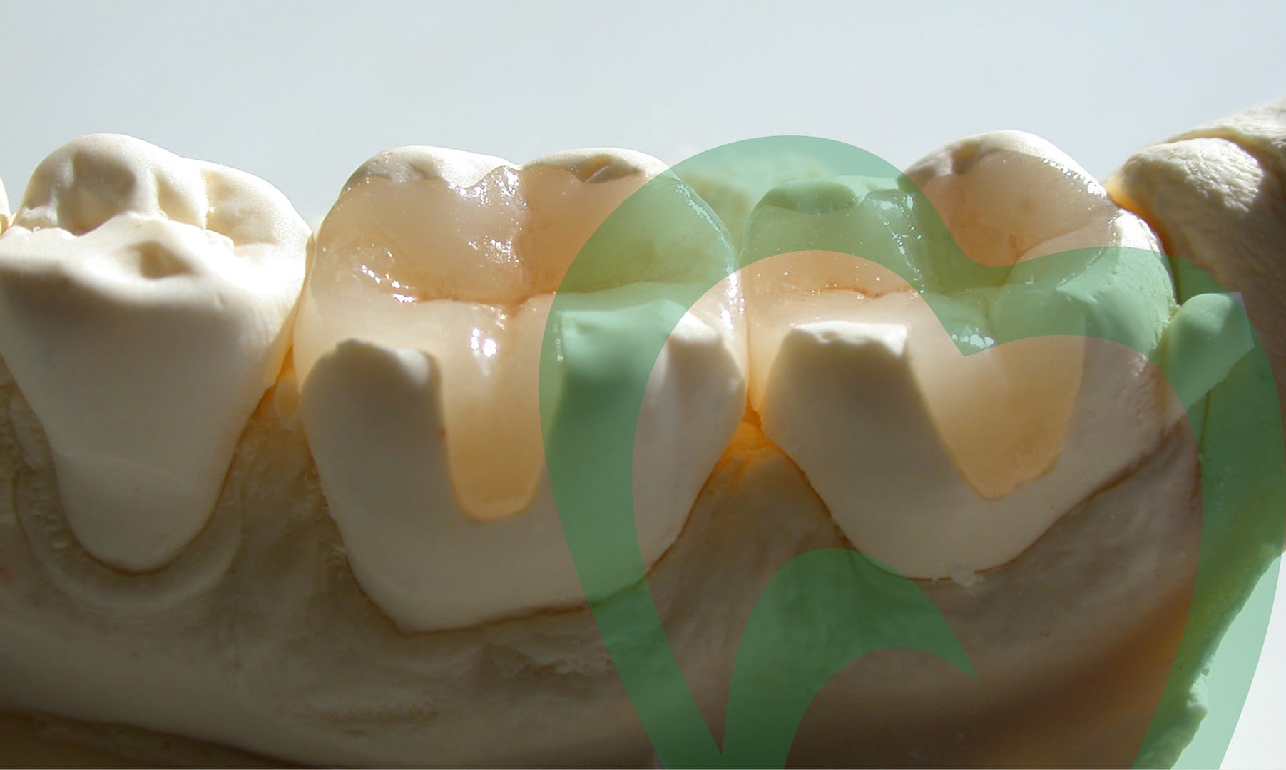 What Are Inlays and Onlays? Here’s the Inside Scoop!