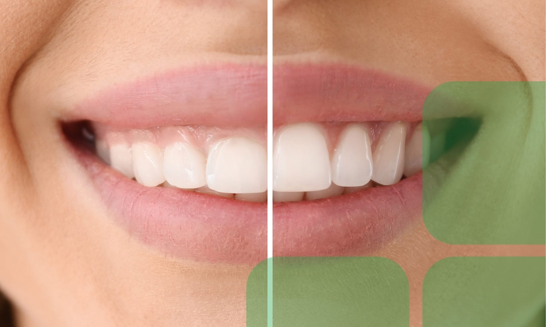 Gum Contouring: Your Route to a Perfect Smile