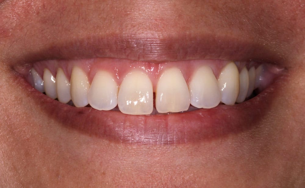 Invisalign - Luminous Smiles of Newport Beach CA