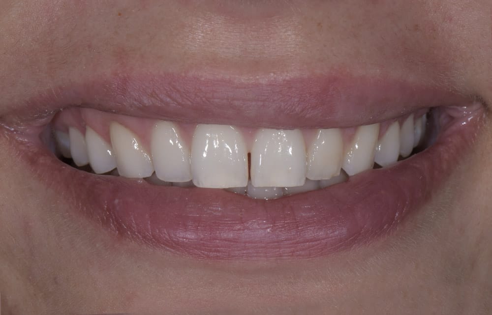 Cosmetic Dentistry in Newport Beach CA | Luminous Smiles