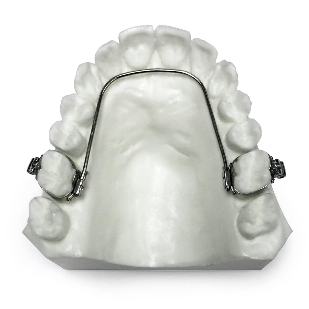 Fixed Lingual Controlled Arch - Ortho Arch