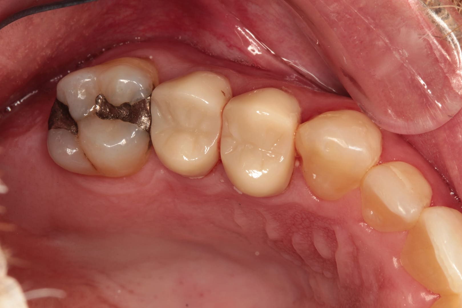 Inlays Onlays and Crowns - Oxley Comprehensive Dentistry