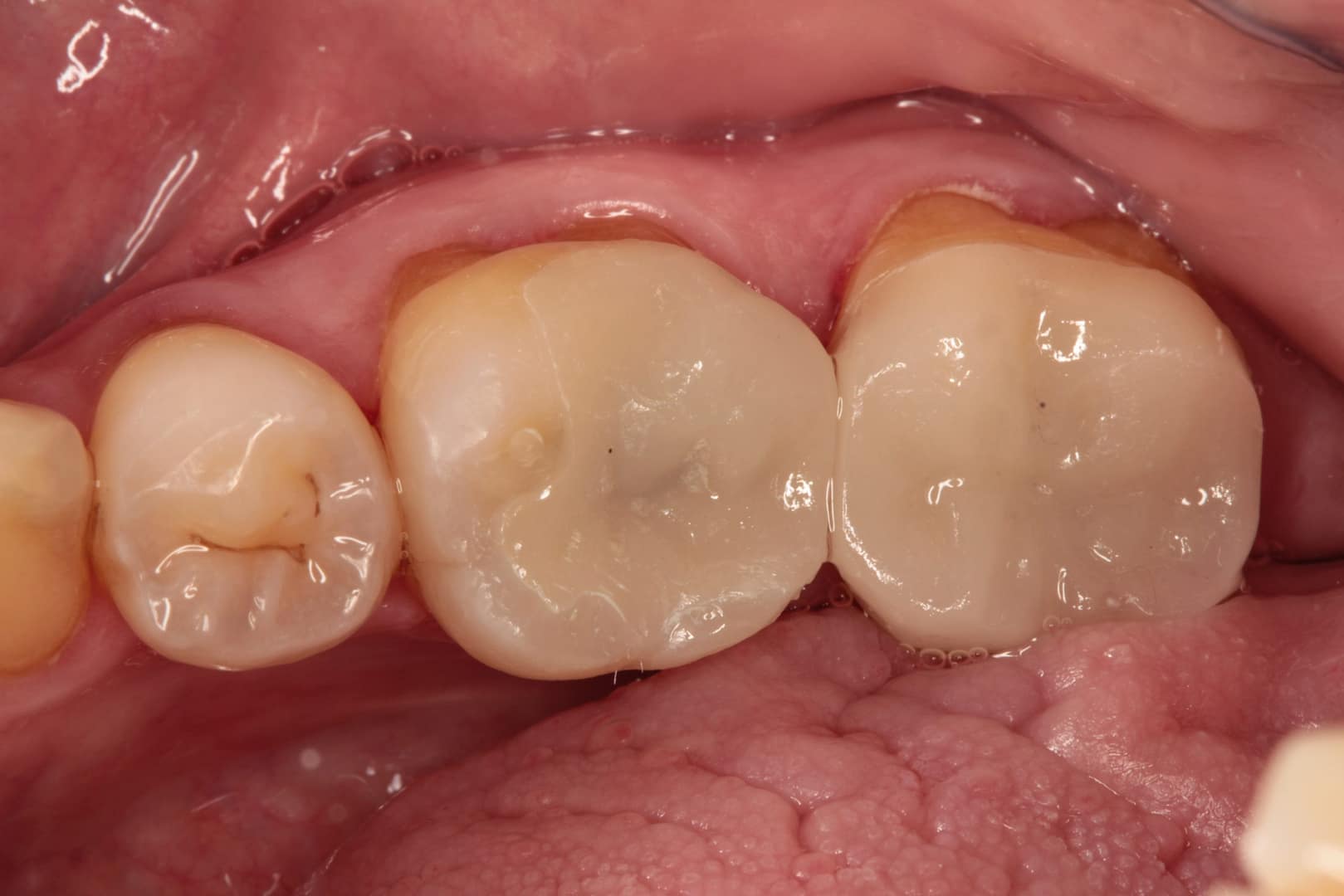 Inlays Onlays and Crowns - Oxley Comprehensive Dentistry
