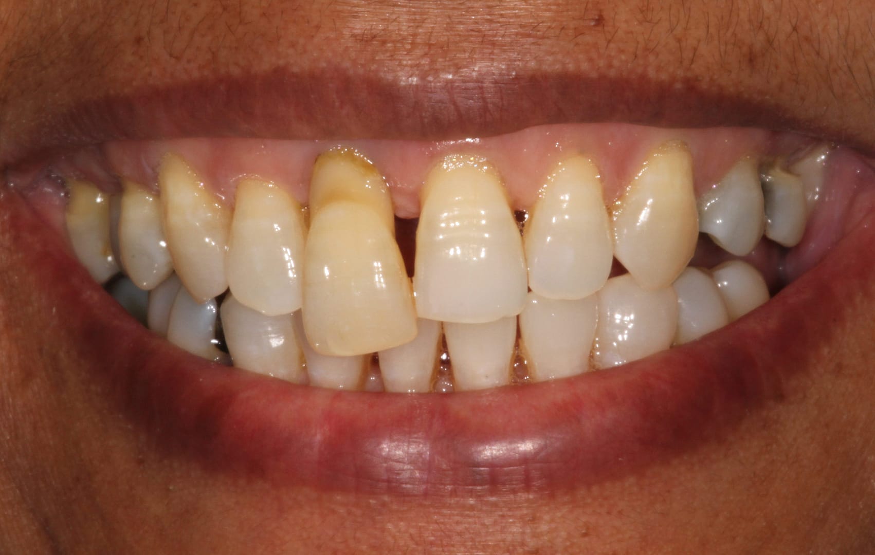 Porcelain Restoration and Gum Contouring | Luminous Smiles