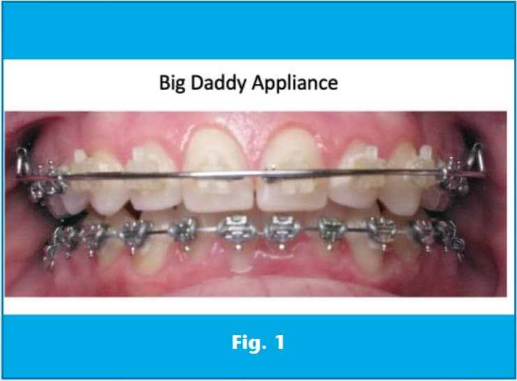 Tooth Movements: Effectively Bodily Translation of Teeth Using the Big ...