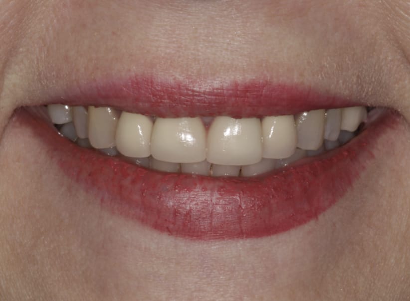 Smile Enhancement | Luminous Smiles