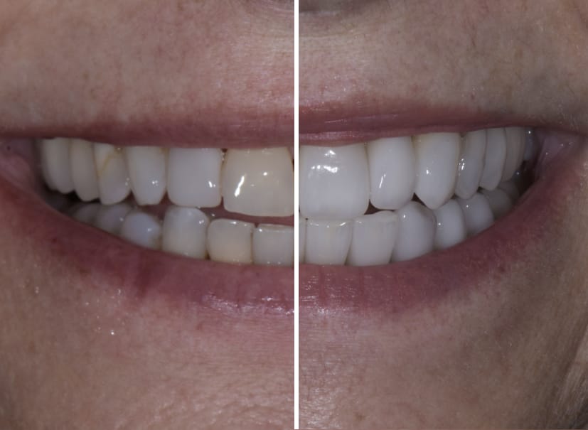 Eliminating Black Triangles and Mismatched Teeth | Luminous Smiles