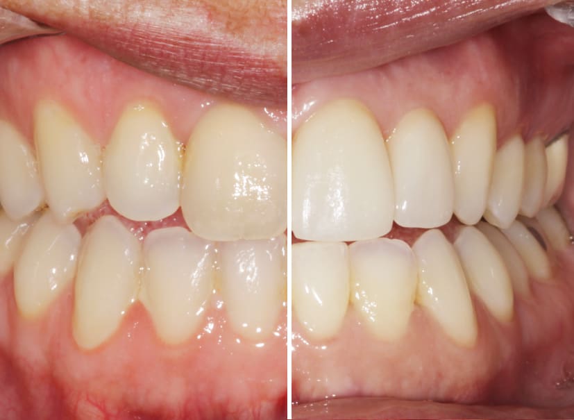 A Dark Tooth and an Asymmetrical Smile | Luminous Smiles