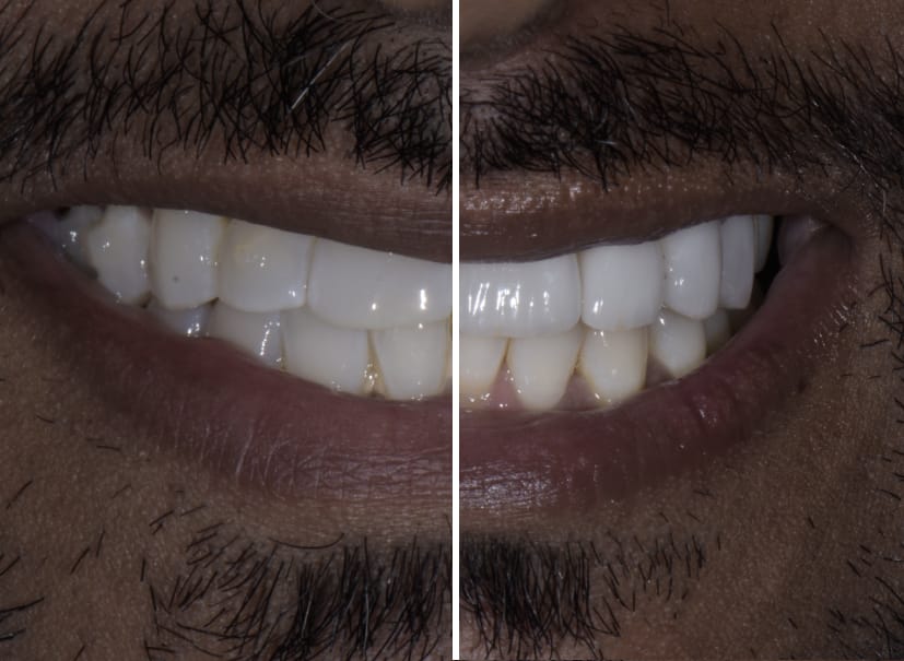 Perfecting His Smile | Luminous Smiles