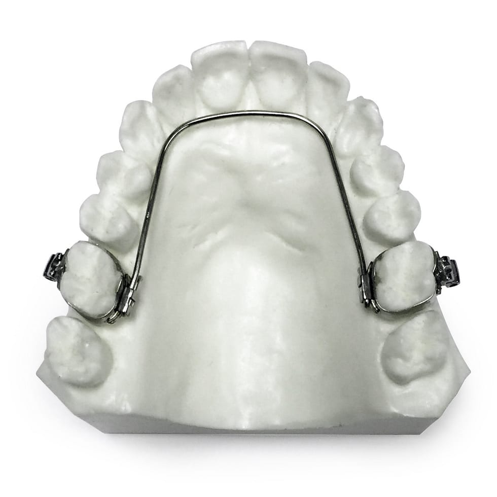 Fixed Lingual Controlled Arch - Ortho Arch