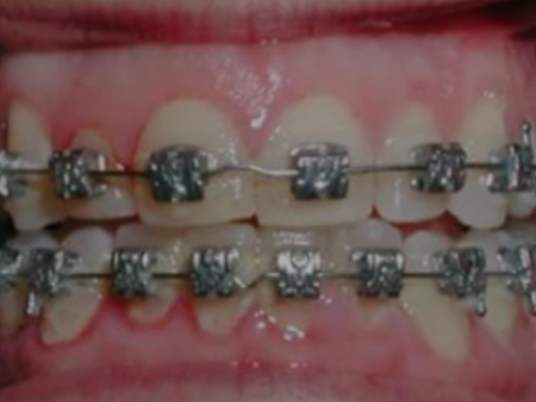 Passive Self-Ligation Bracket System: How Arch Wires & Sequencing ...