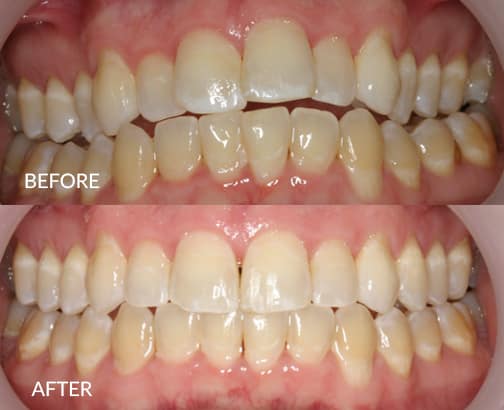 Invisalign and Upper Dental Arch Expansion - Dallas Cosmetic Dental