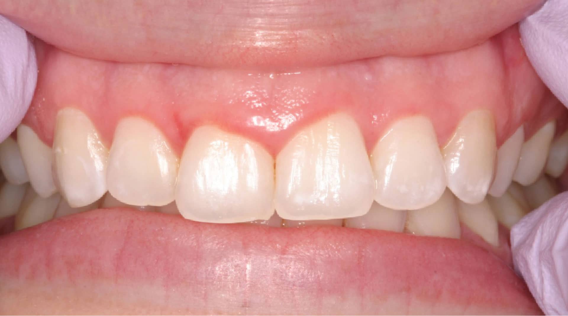 Cosmetic Dentistry - Dallas Cosmetic Dental - Dallas, TX