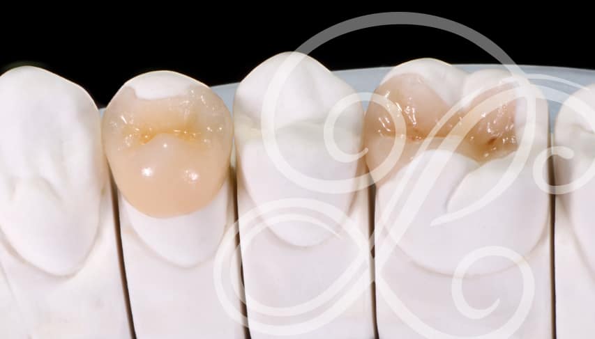 When Are Dental Inlays and Onlays the Best Choice?