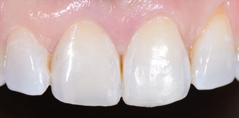 Composite Bonding | Luminous Smiles of Newport Beach CA