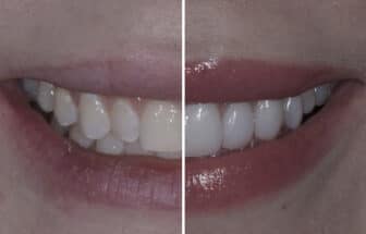 Procedures | Luminous Smiles